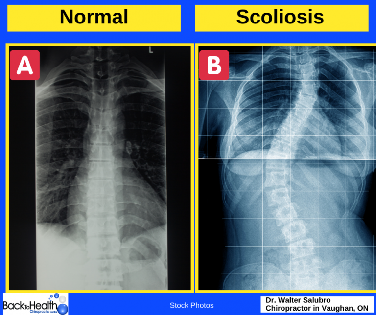 Normal vs scoliosis | Looking For A Chiropractor In Vaughan? Call (905 ...