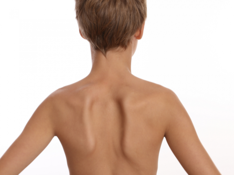 adolescent-teen-scoliosis-winging-scapula | Looking For A Chiropractor ...