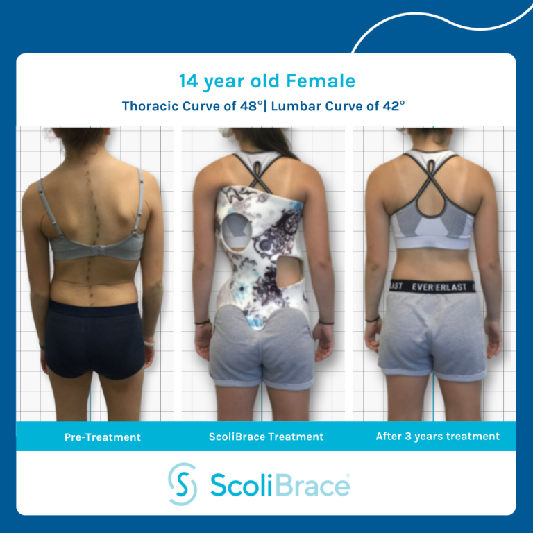 ScoliBrace: A 3D Corrective Scoliosis Brace for Children and Adults ...