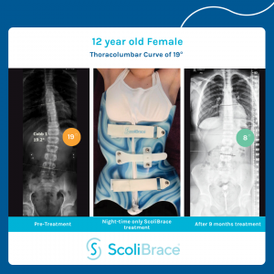 ScoliBrace: A 3D Corrective Scoliosis Brace for Children and Adults ...