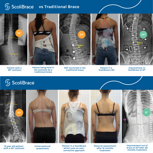ScoliBrace: A 3D Corrective Scoliosis Brace for Children and Adults ...